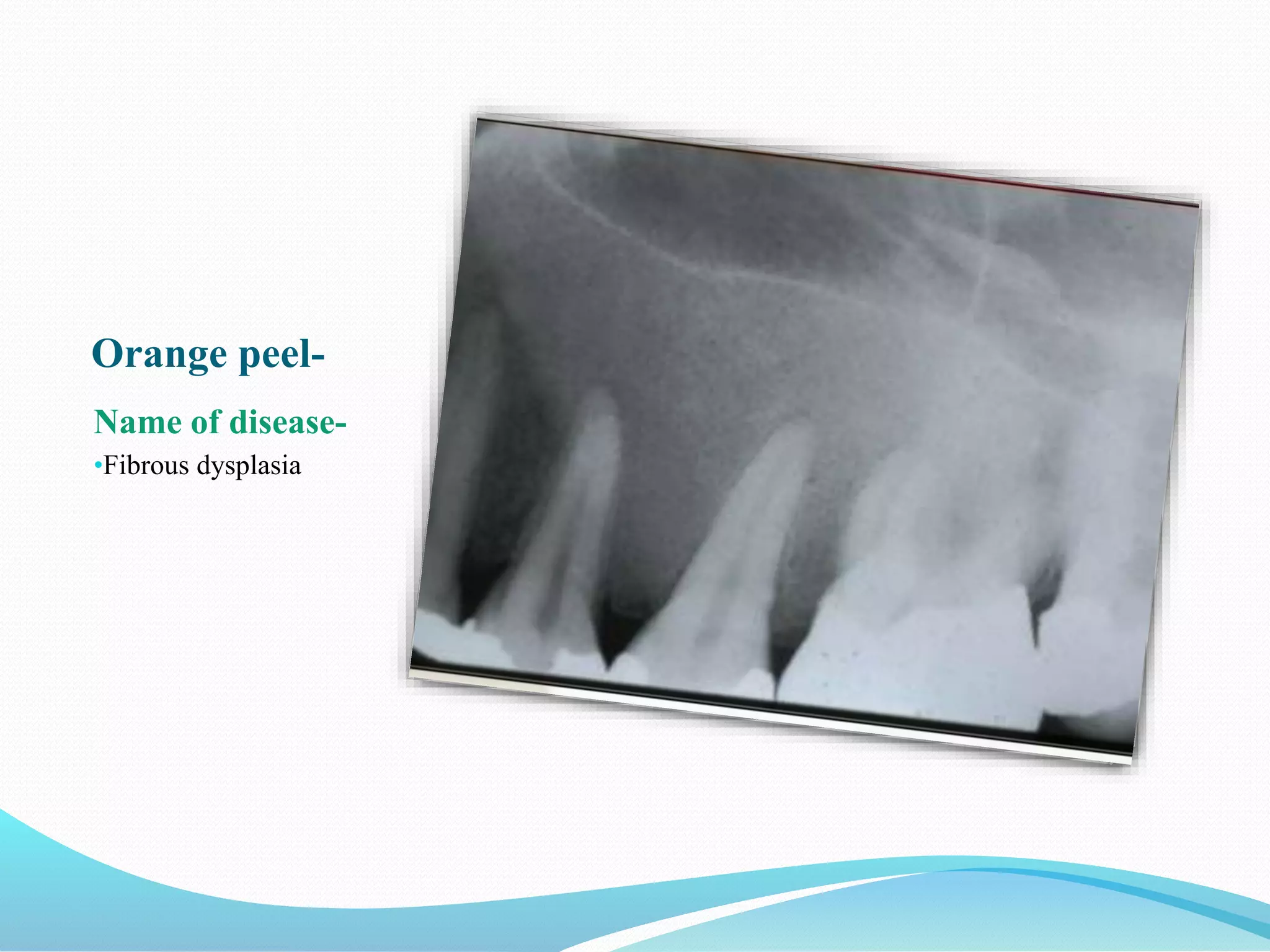 Typical radiological feature | PPTX