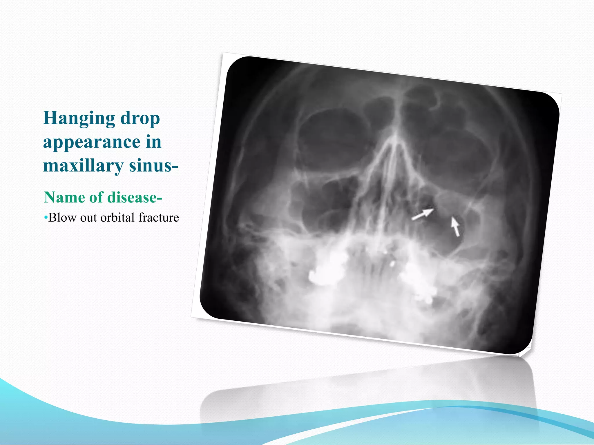 Typical radiological feature | PPTX