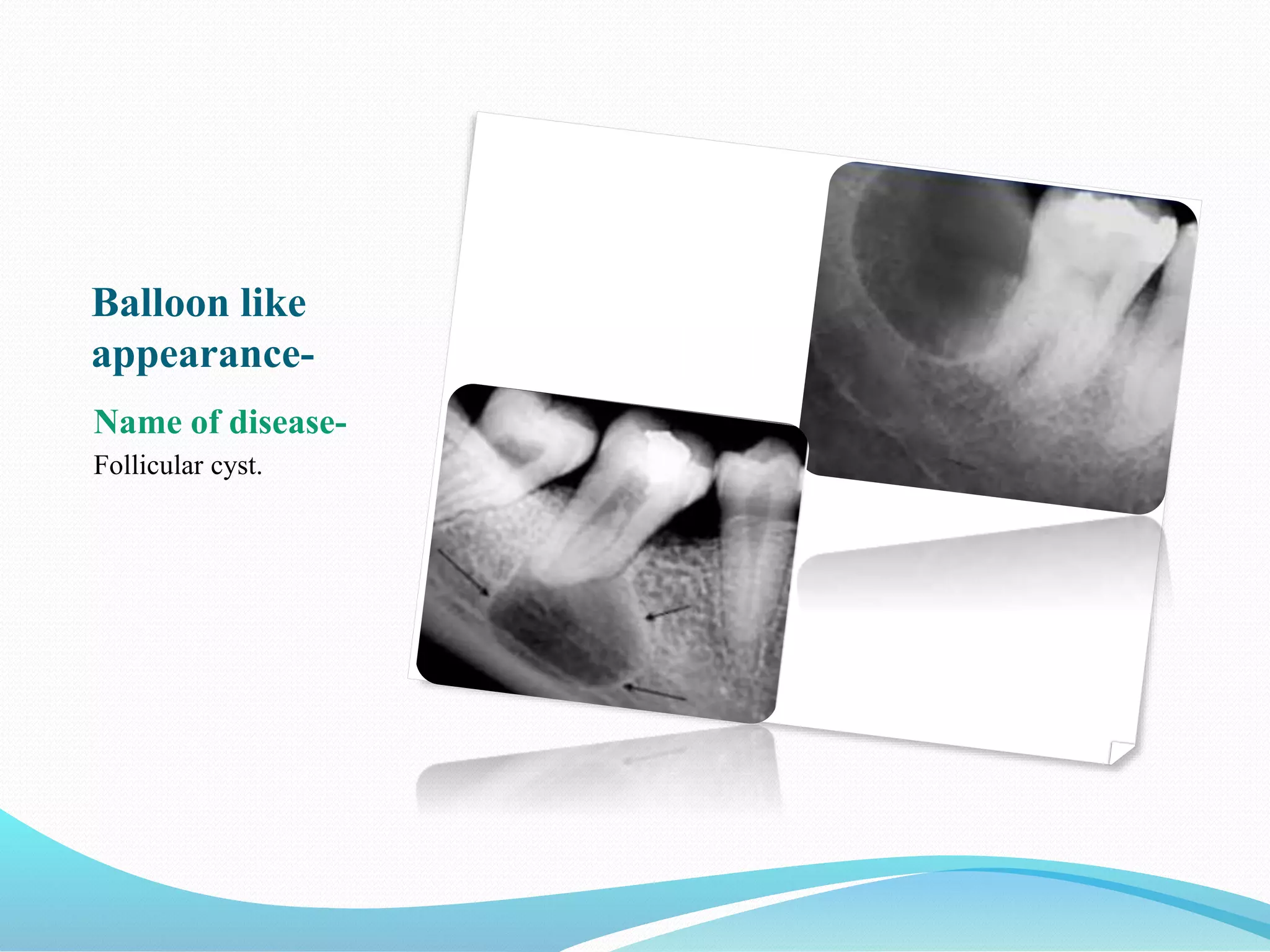 Typical radiological feature | PPTX