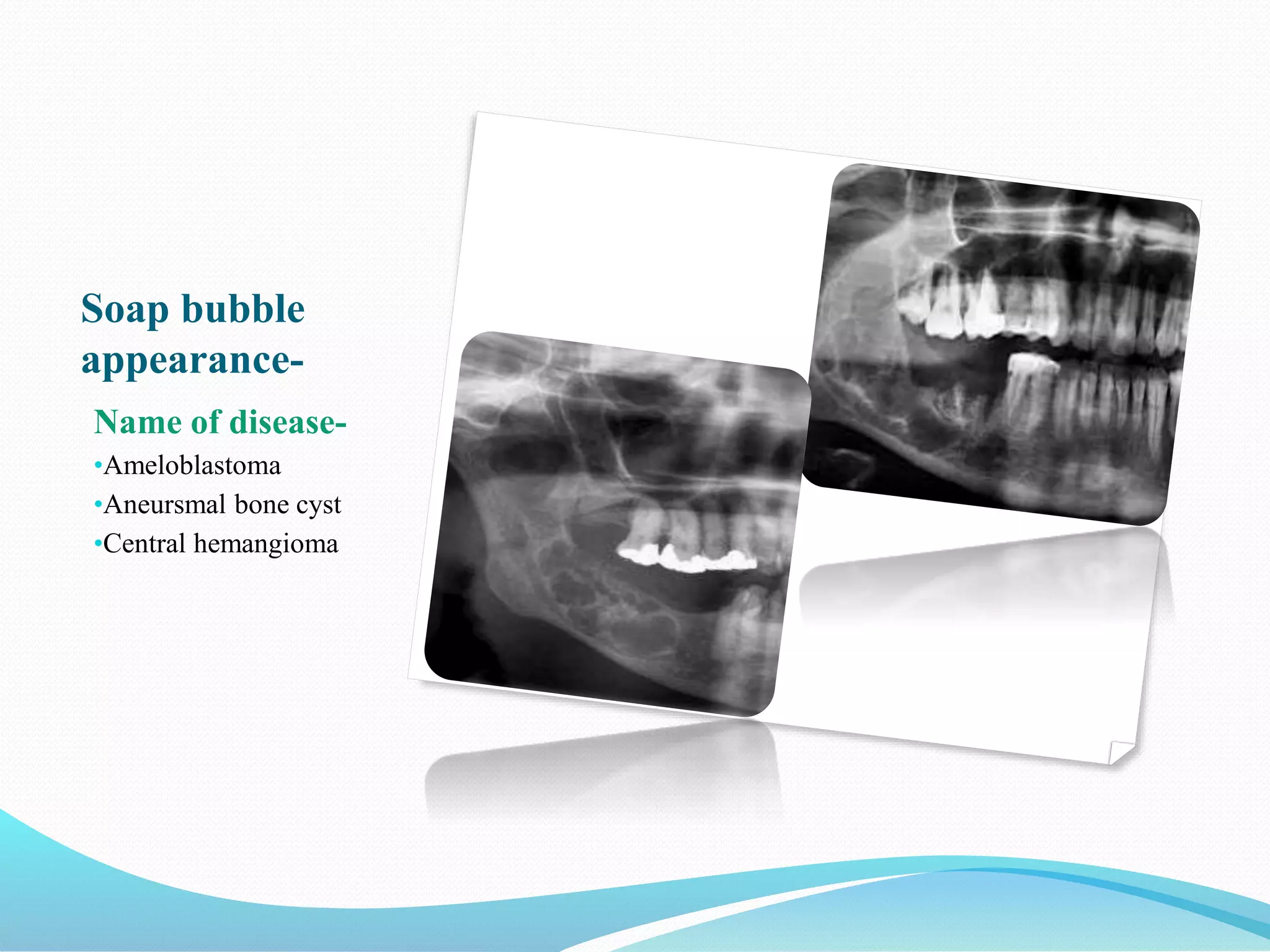 Typical radiological feature | PPTX