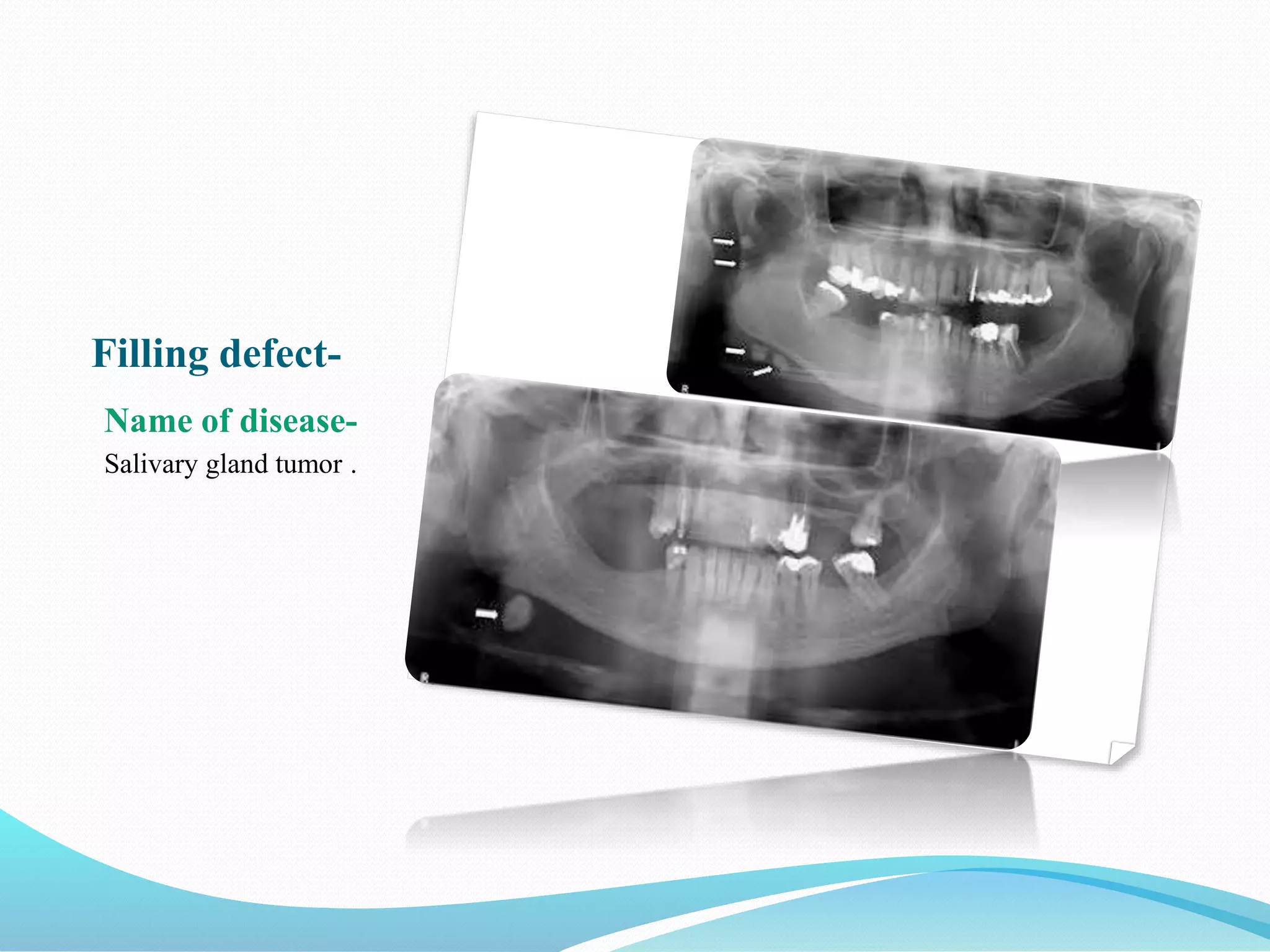 Typical radiological feature | PPTX