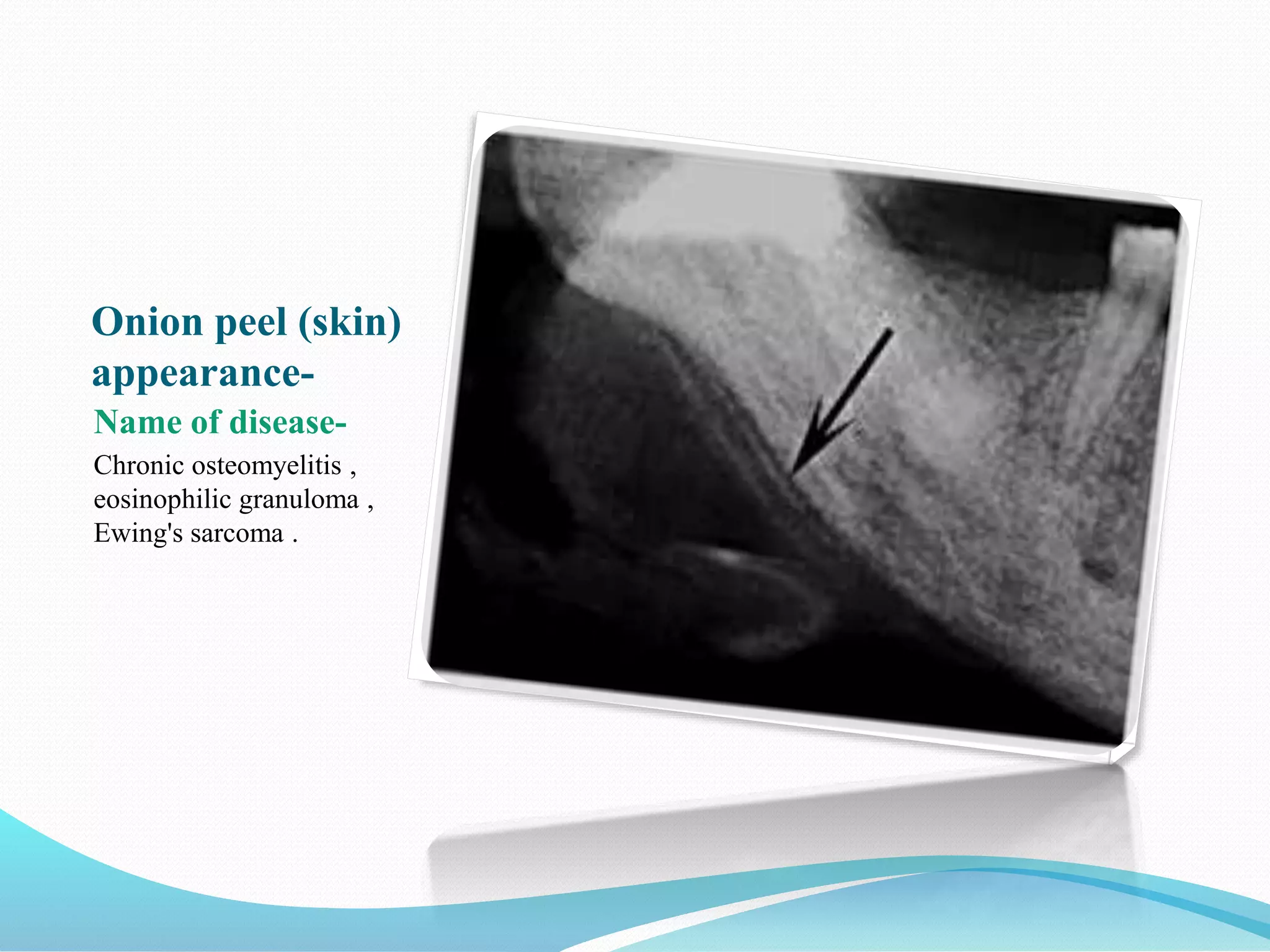 Typical radiological feature | PPTX