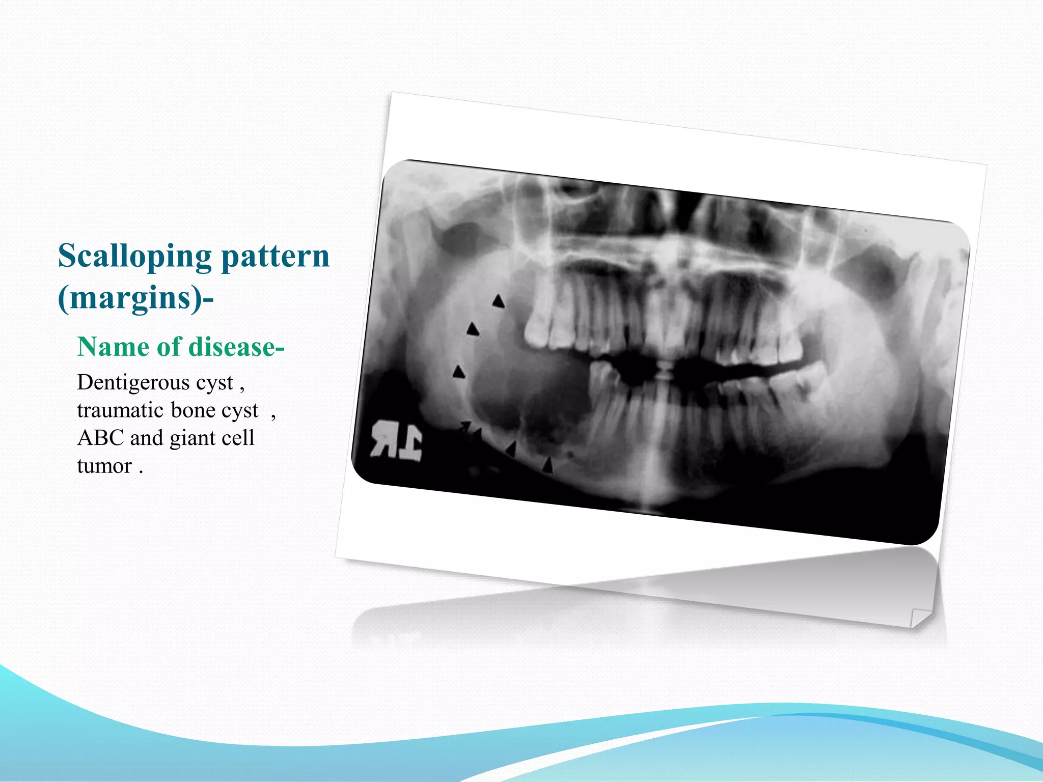 Typical radiological feature | PPTX