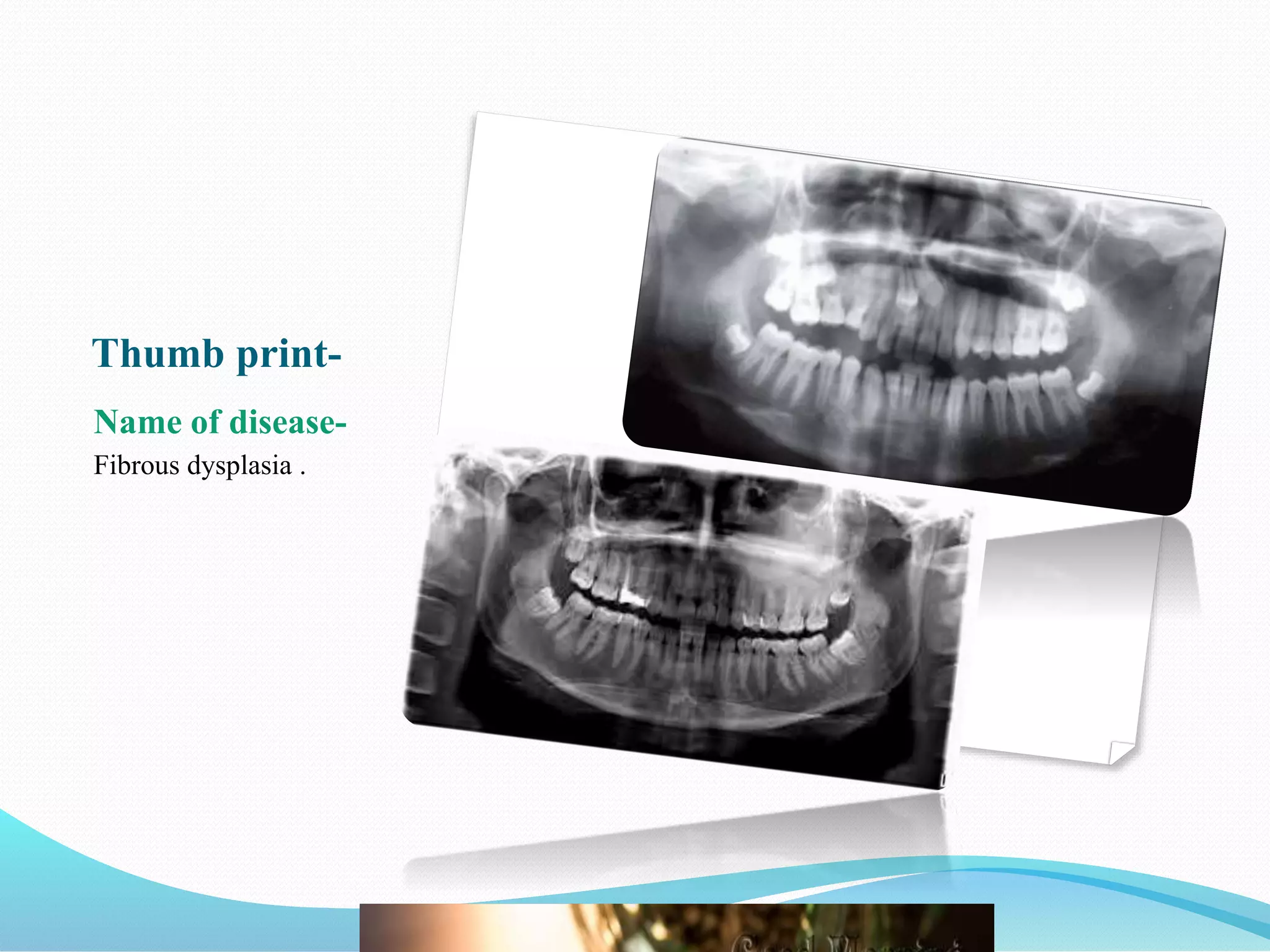 Typical radiological feature | PPTX