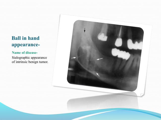 Typical radiological feature | PPTX