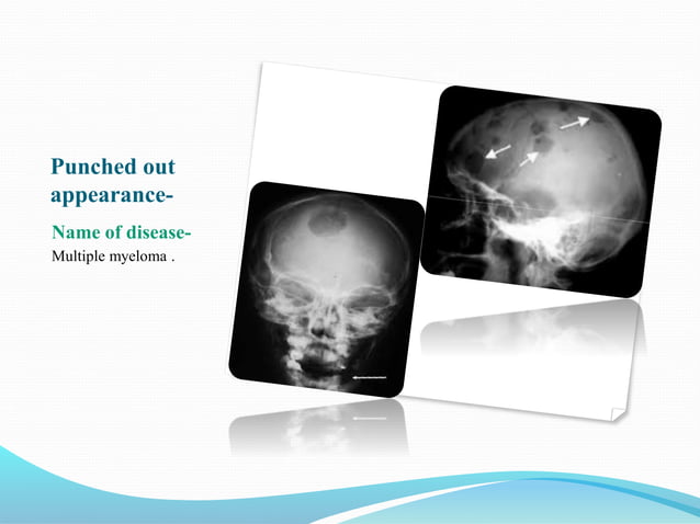 Typical radiological feature | PPTX