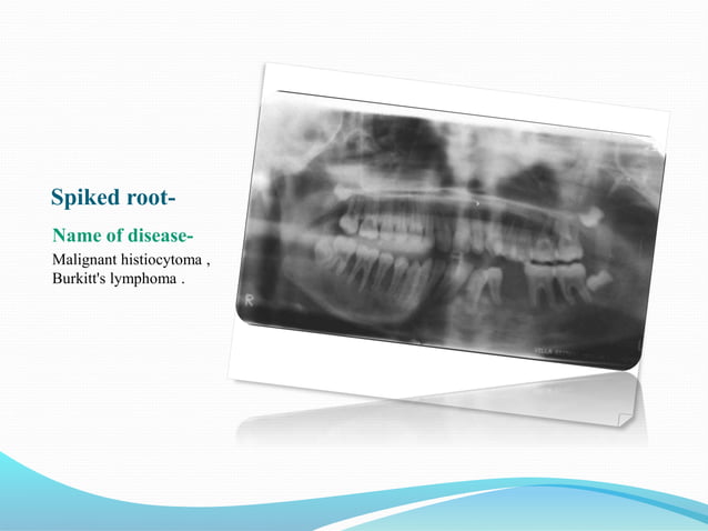 Typical radiological feature | PPTX