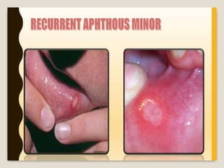 recurrent apthous ulcer | PPTX