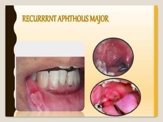 recurrent apthous ulcer | PPTX