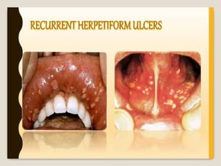 recurrent apthous ulcer | PPTX