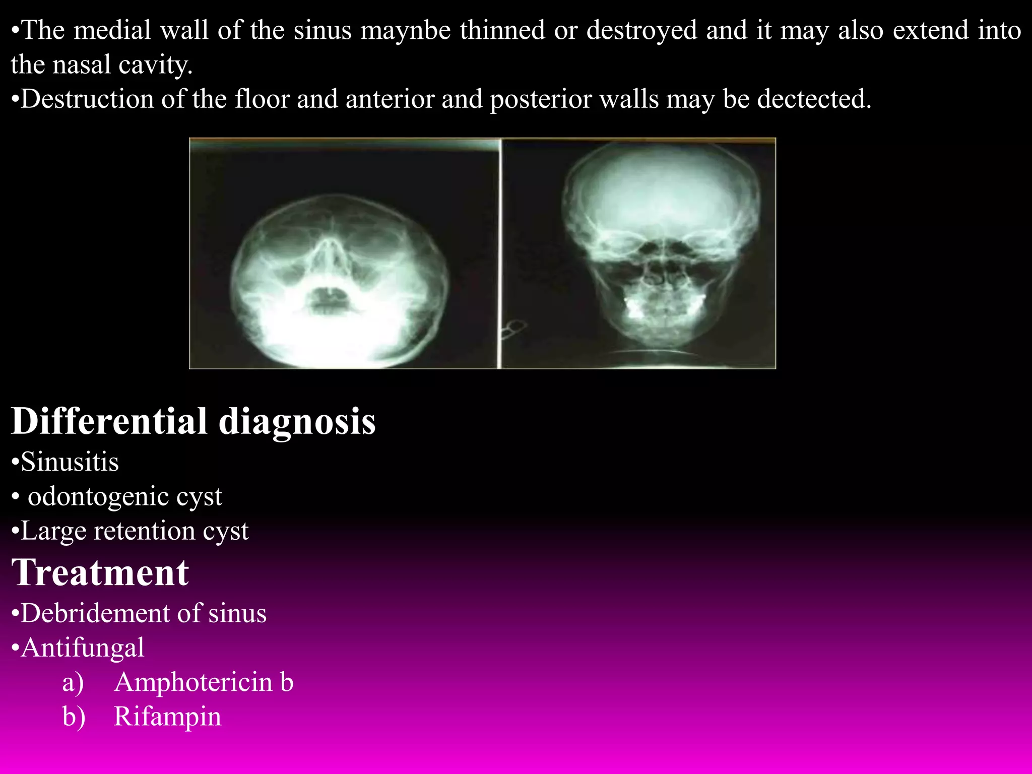 Differential Diagnosis Of Maxillary Sinus Pathology | PPTX