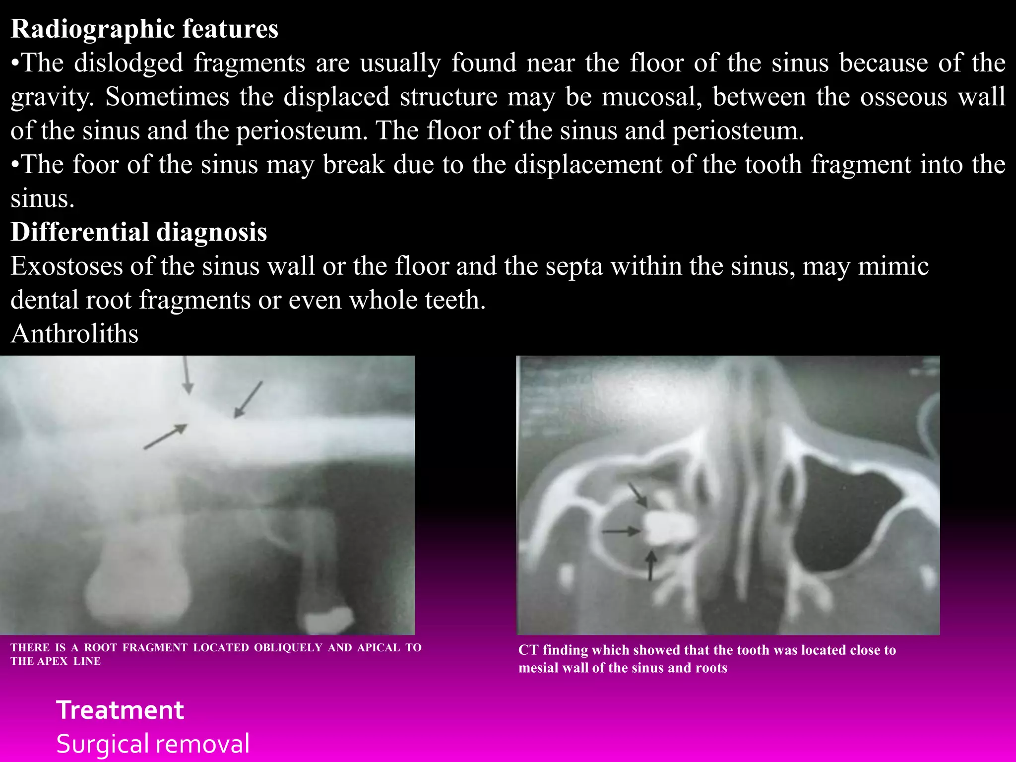 Differential Diagnosis Of Maxillary Sinus Pathology | PPTX