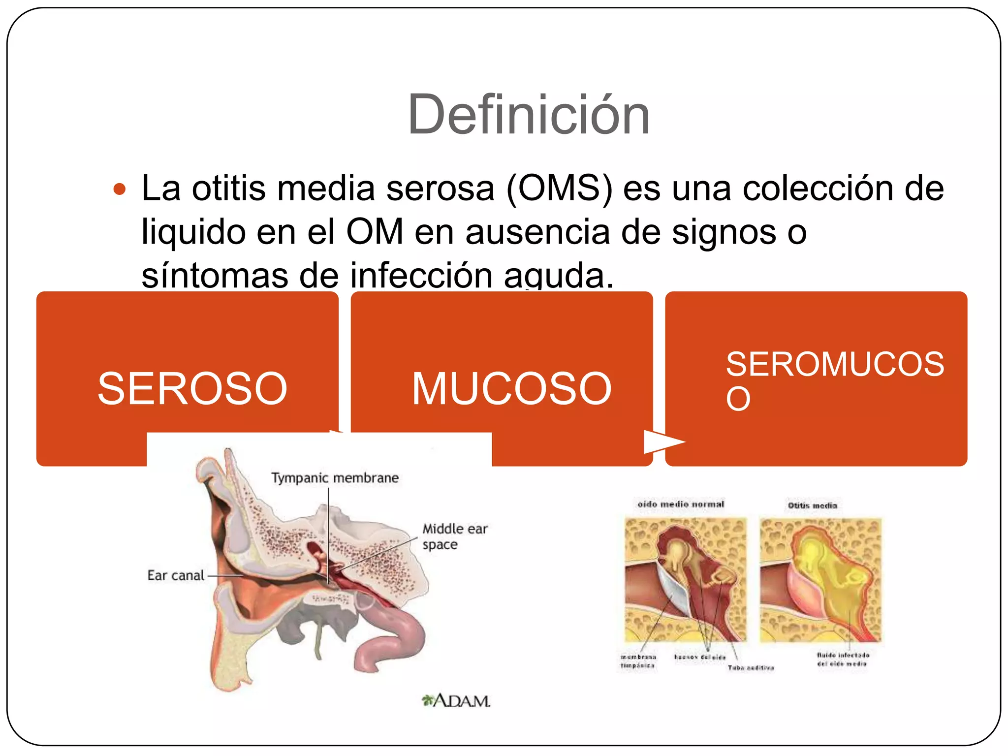 OTITIS MEDIA SEROSA | PPT