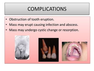 ODONTOMA PPTX odontoma-pptx