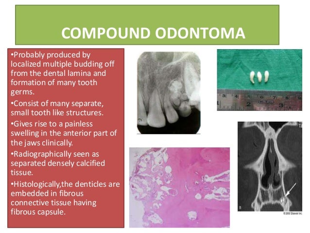 ODONTOMA
