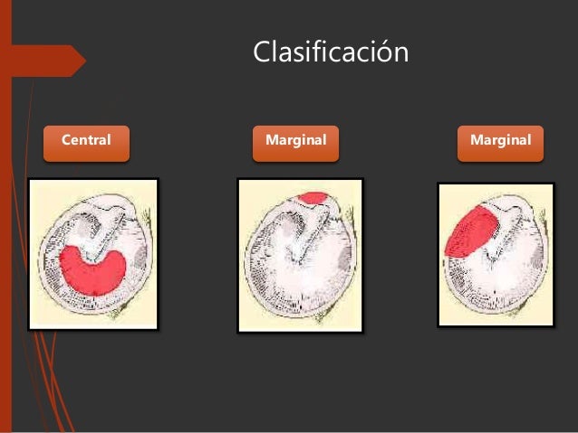 Otitis media secretora