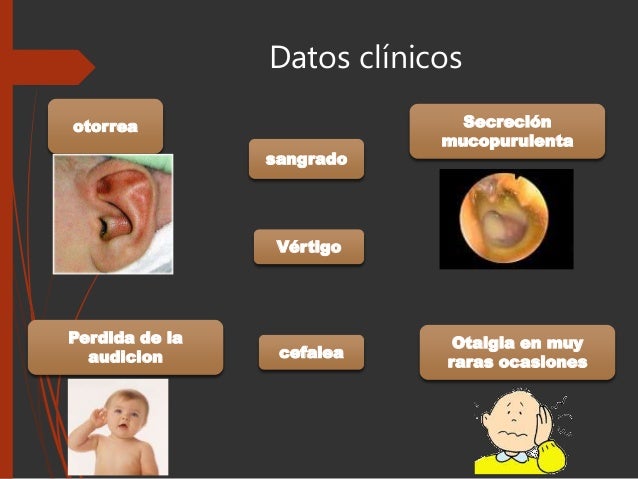 Otitis media secretora