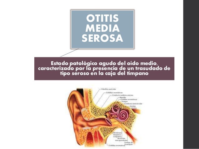 Otitis media serosa