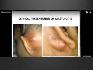 OMSK_DAN_MASTOIDITIS.pptx