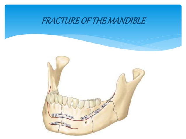 Fractures of mandible and detailed discussion | PPT