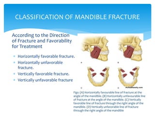 Fractures of mandible and detailed discussion | PPTX