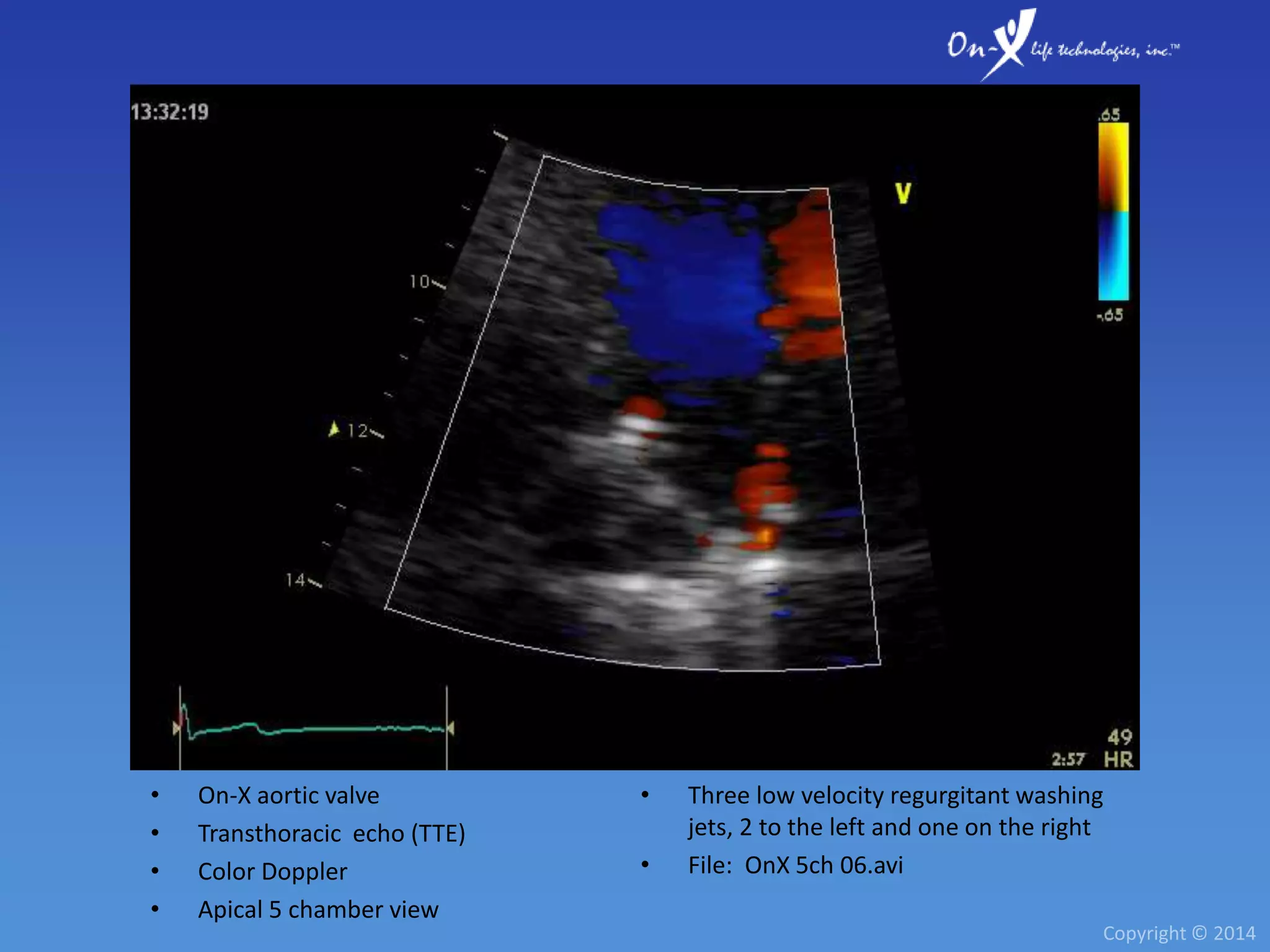 On-X Heart Valve Echocardiography | PPTX