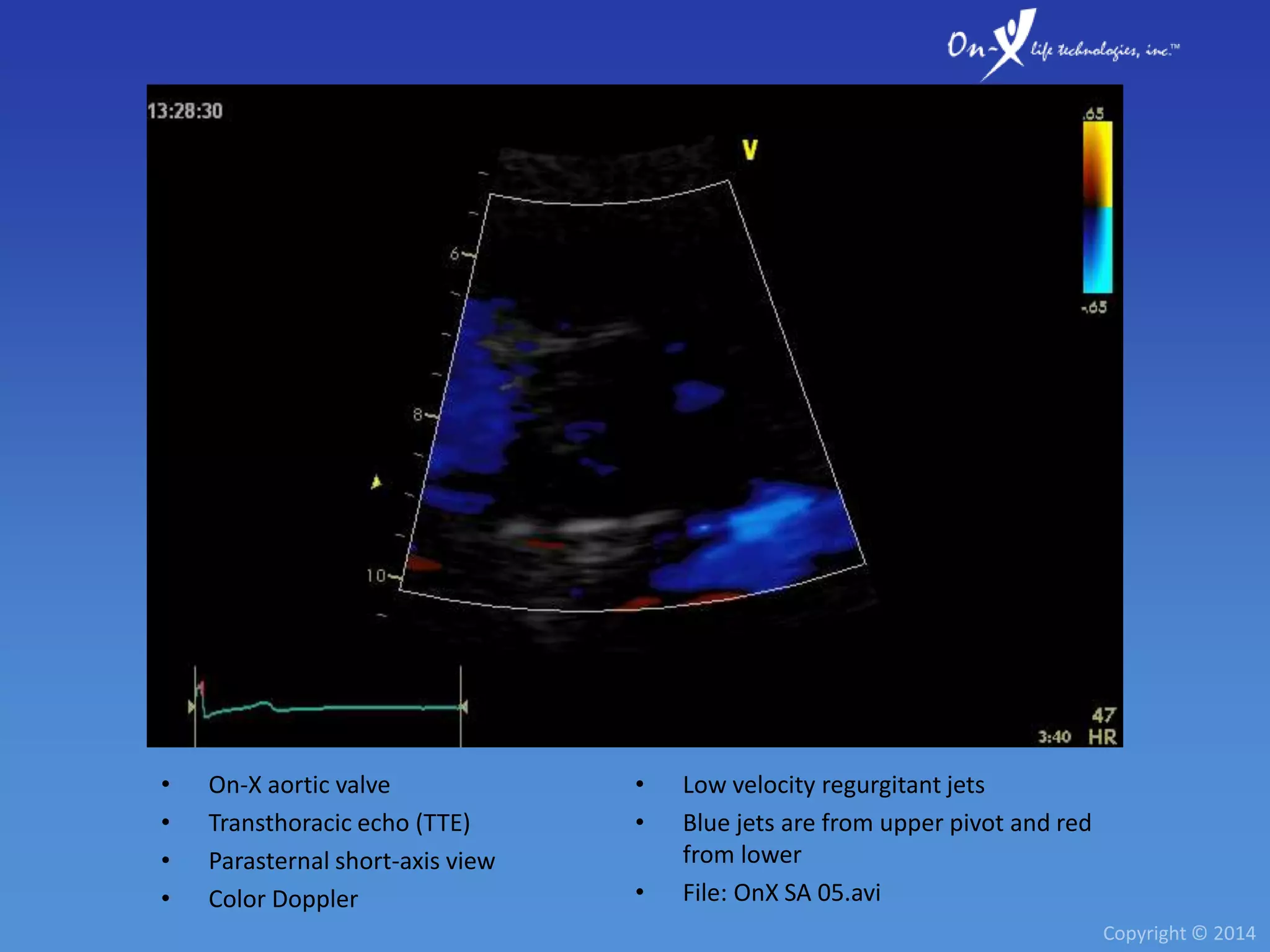 On-X Heart Valve Echocardiography | PPTX