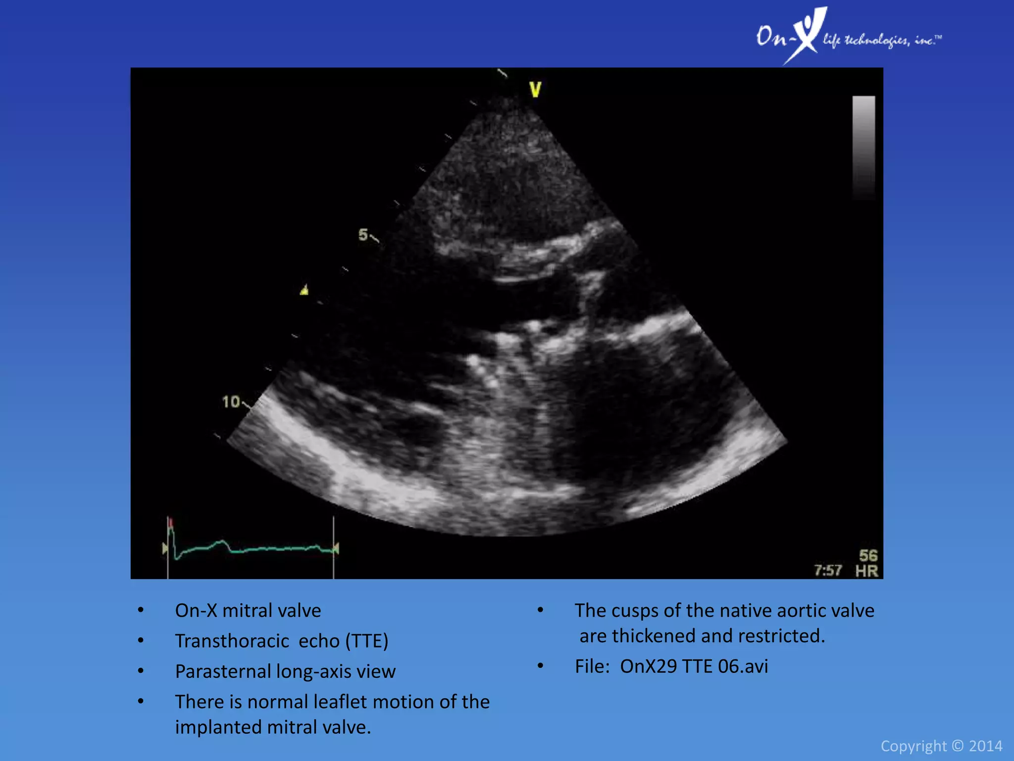 On-X Heart Valve Echocardiography | PPTX