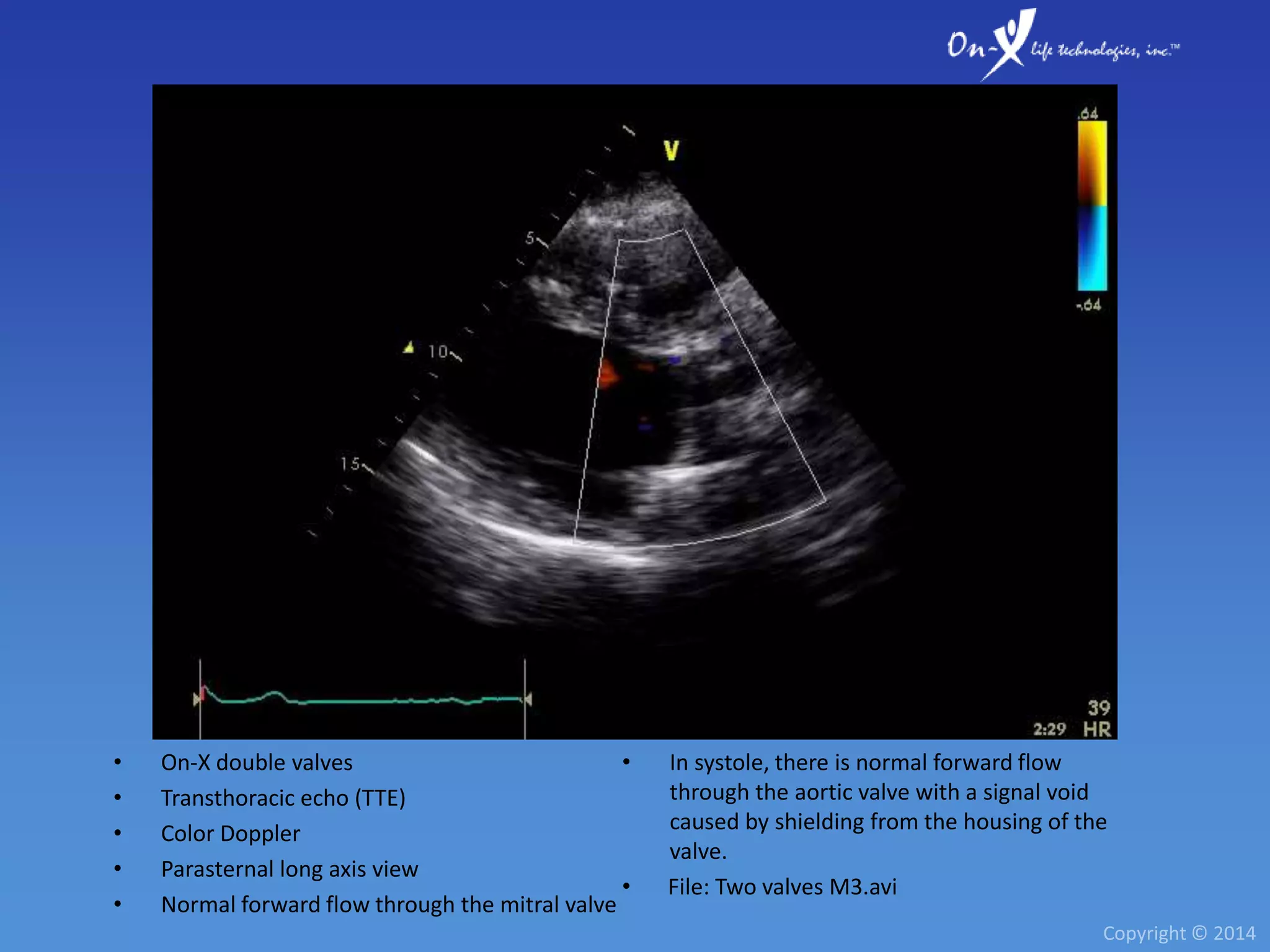On-X Heart Valve Echocardiography | PPTX