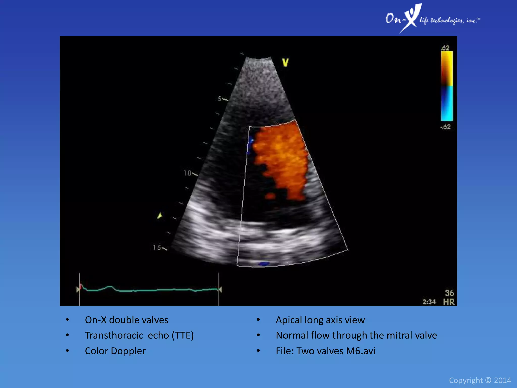 On-X Heart Valve Echocardiography | PPTX