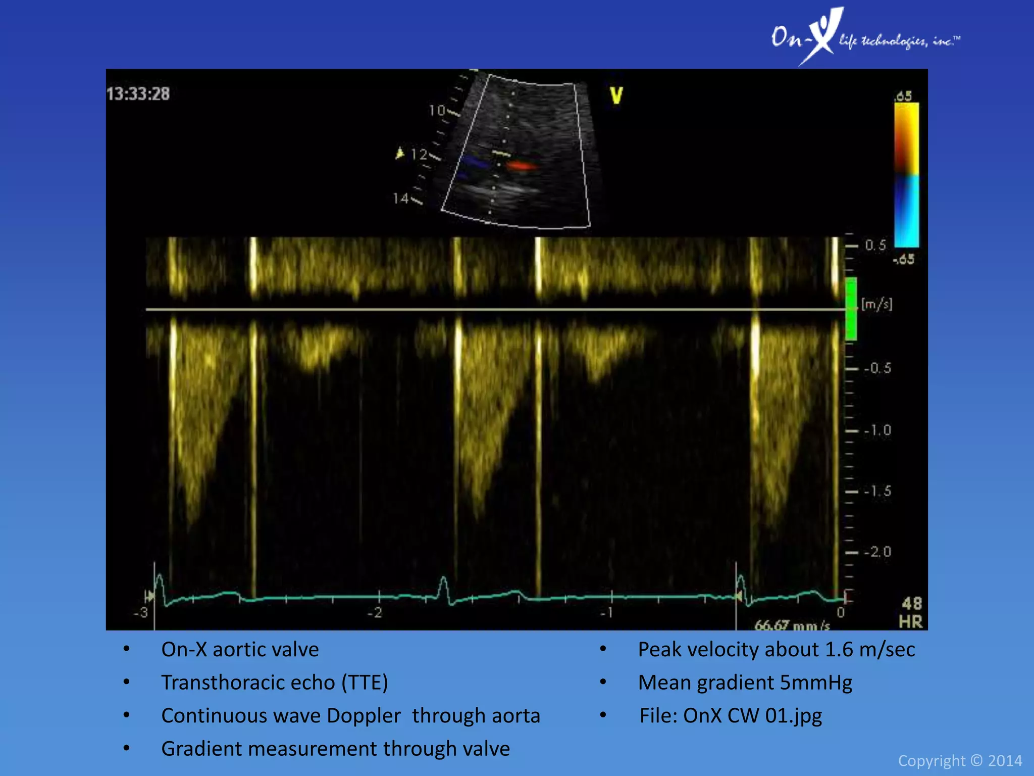 On-X Heart Valve Echocardiography | PPTX
