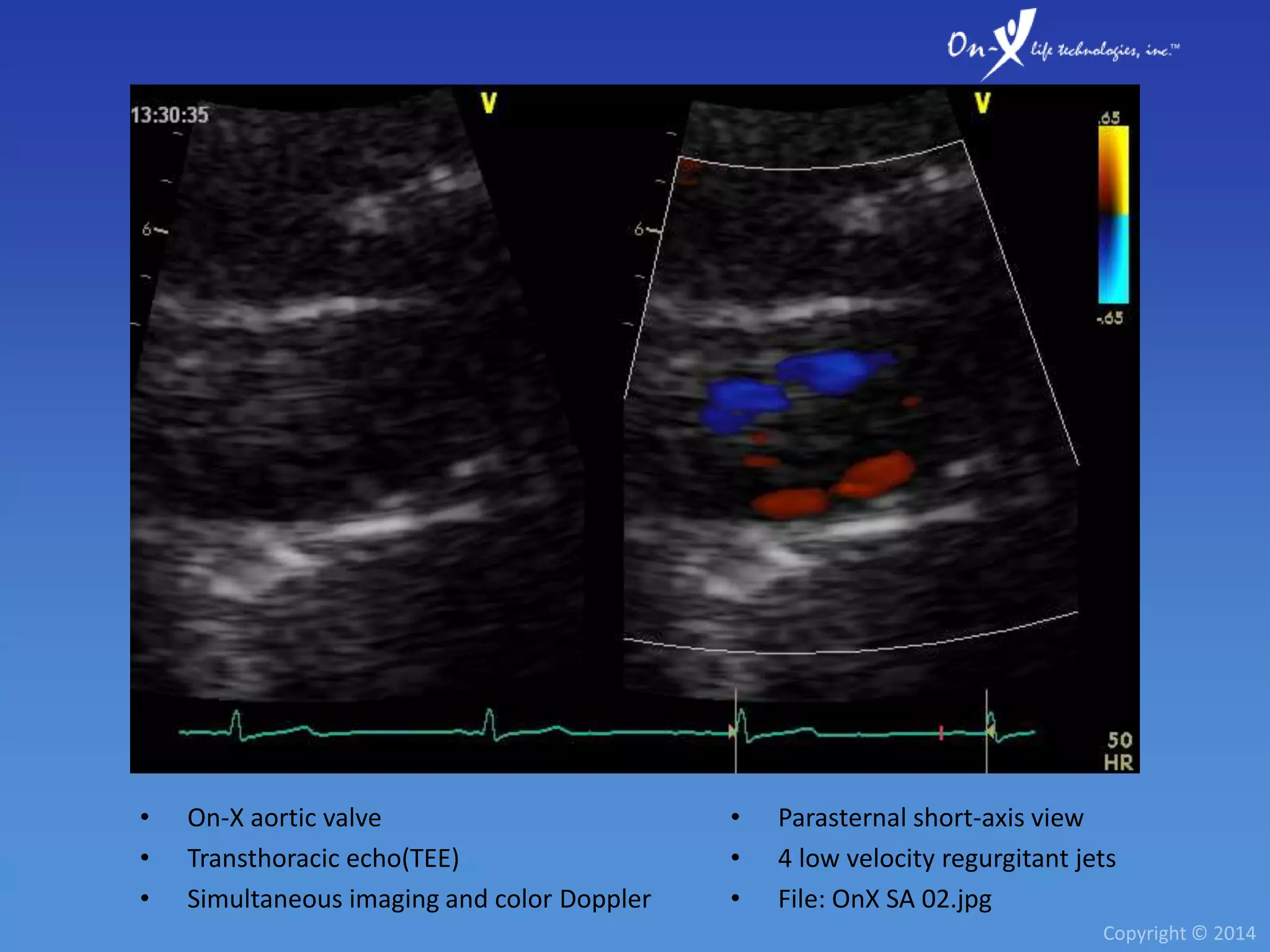 On-X Heart Valve Echocardiography | PPTX