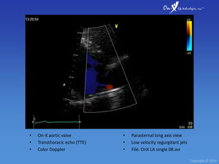 On-X Heart Valve Echocardiography | PPTX