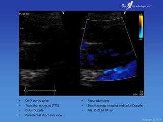 On-X Heart Valve Echocardiography | PPTX