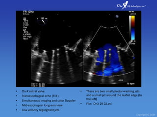 On-X Heart Valve Echocardiography | PPTX