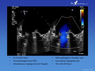 On-X Heart Valve Echocardiography | PPTX