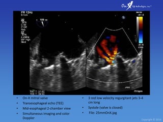 On-X Heart Valve Echocardiography | PPTX
