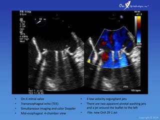 On-X Heart Valve Echocardiography | PPT