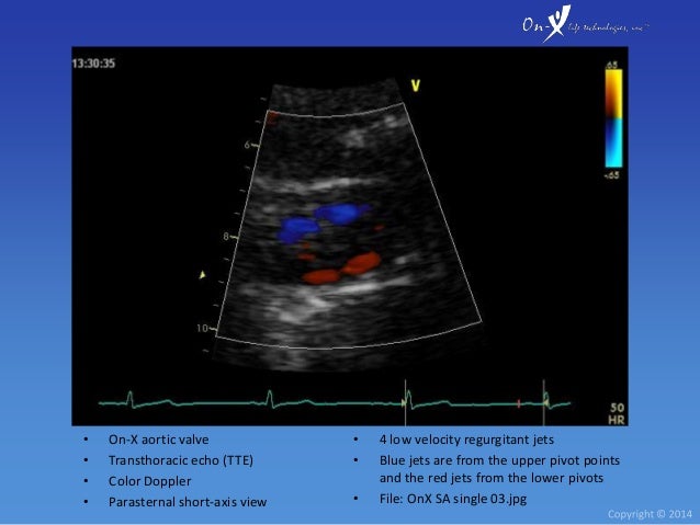 On-X Heart Valve Echocardiography