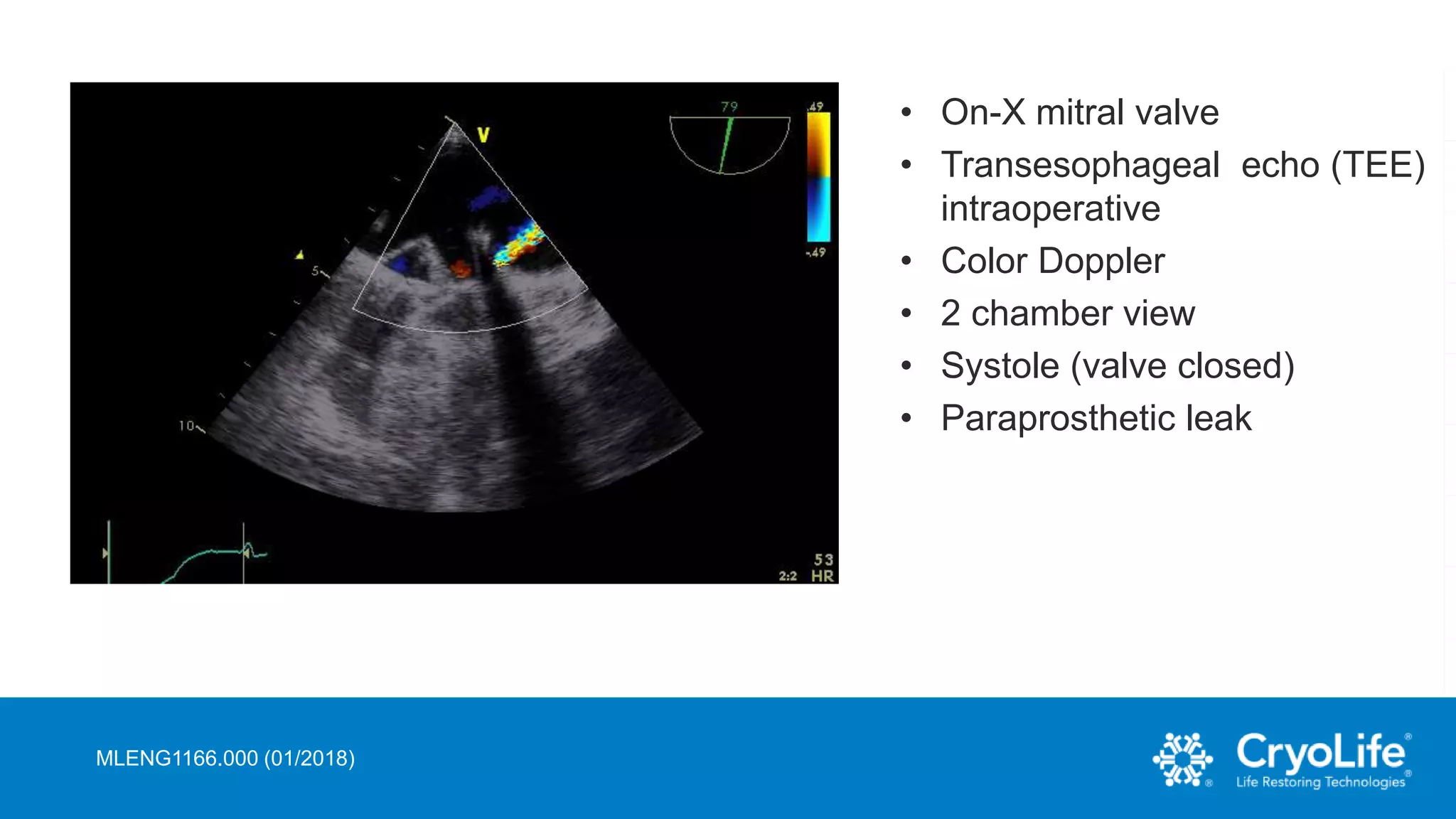 On-X Echocardiography Presentation_MLENG1166.000