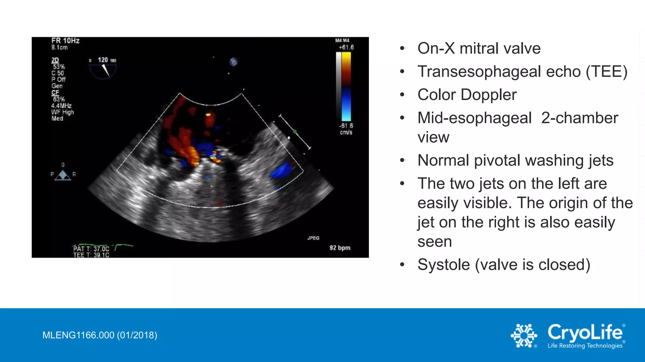 On-X Echocardiography Presentation_MLENG1166.000