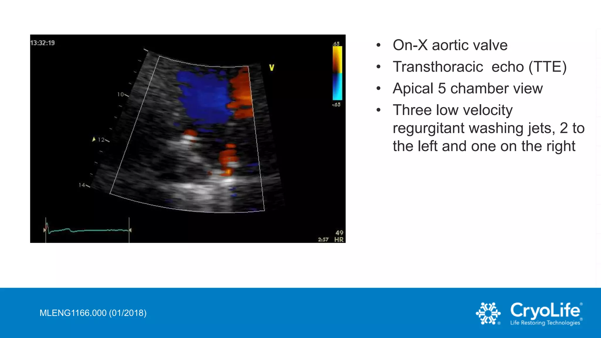 On-X Echocardiography Presentation_MLENG1166.000