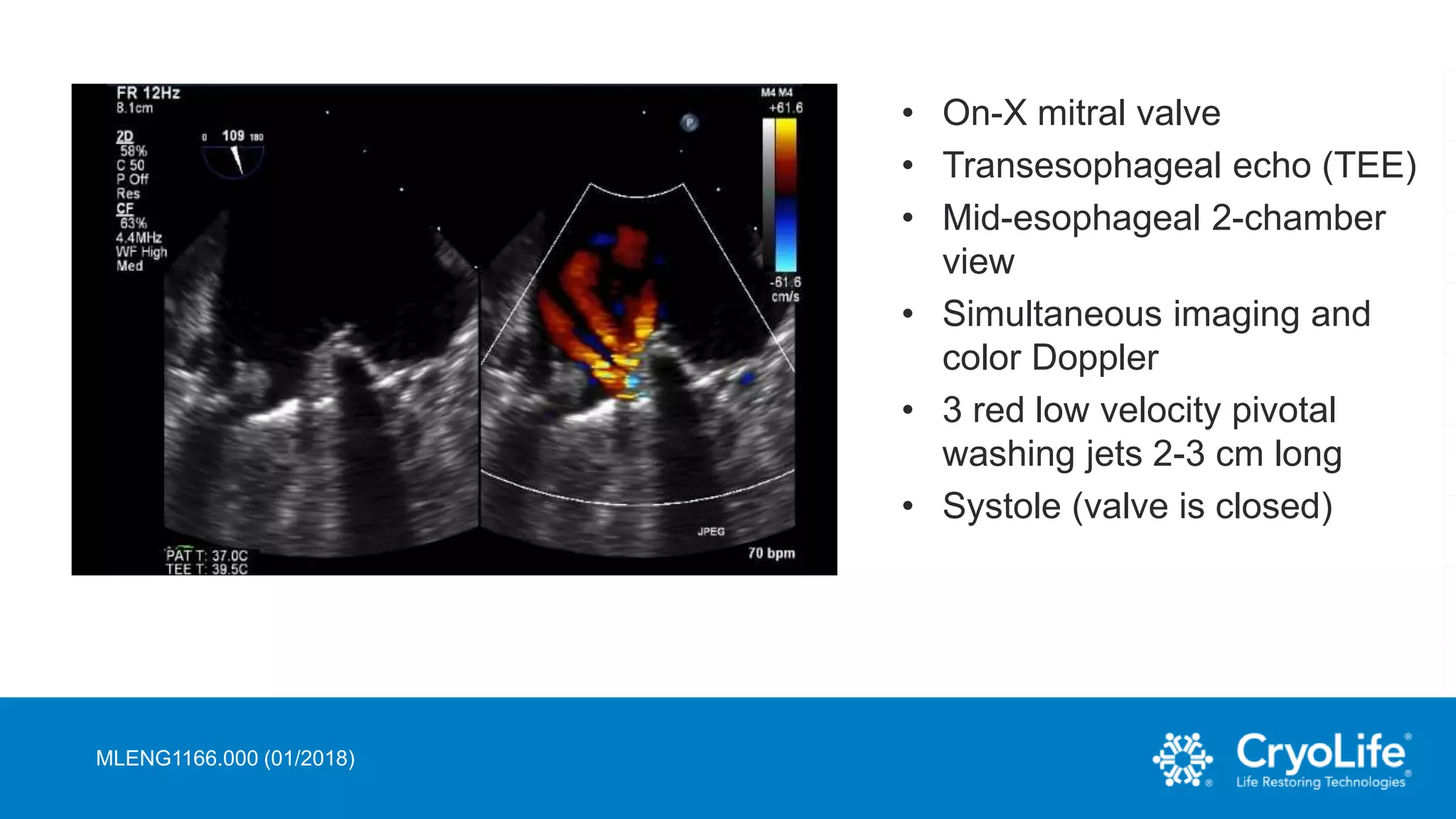 On-X Echocardiography Presentation_MLENG1166.000