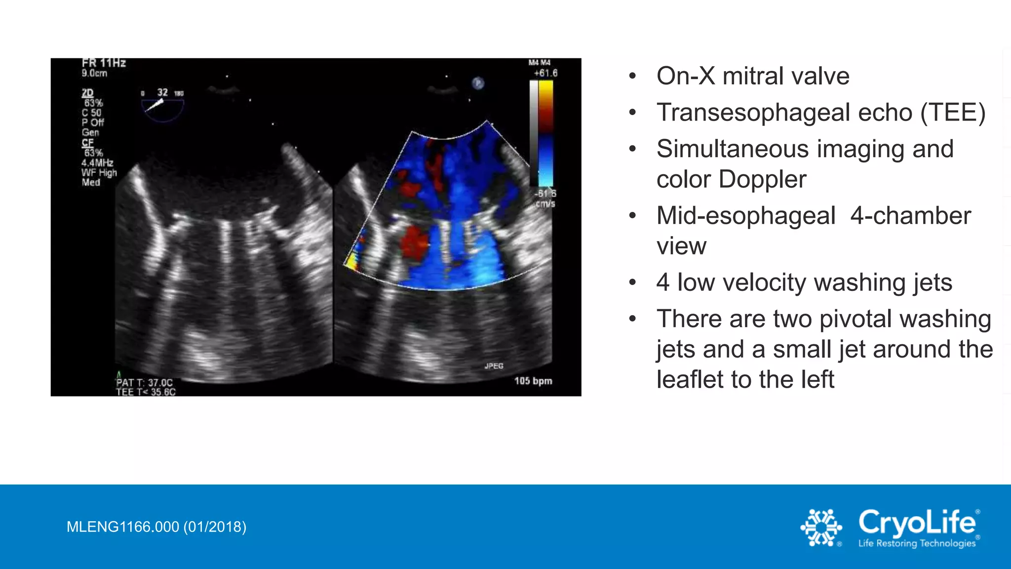 On-X Echocardiography Presentation_MLENG1166.000