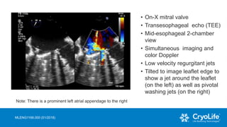 On-X Echocardiography Presentation_MLENG1166.000