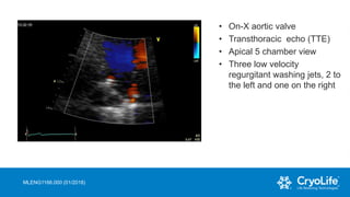 On-X Echocardiography Presentation_MLENG1166.000