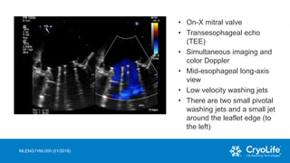 On-X Echocardiography Presentation_MLENG1166.000
