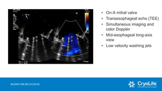 On-X Echocardiography Presentation_MLENG1166.000