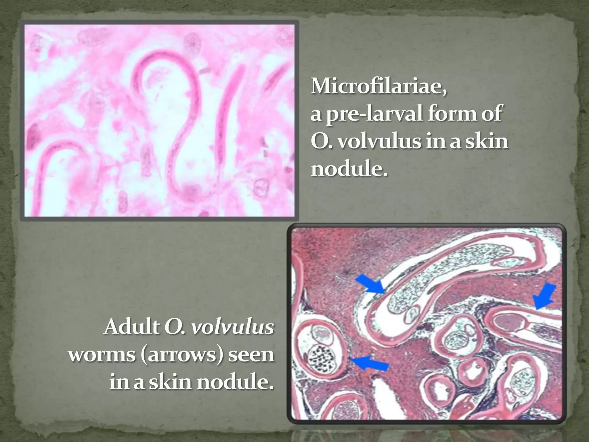 Onchocerca volvulus | PPTX