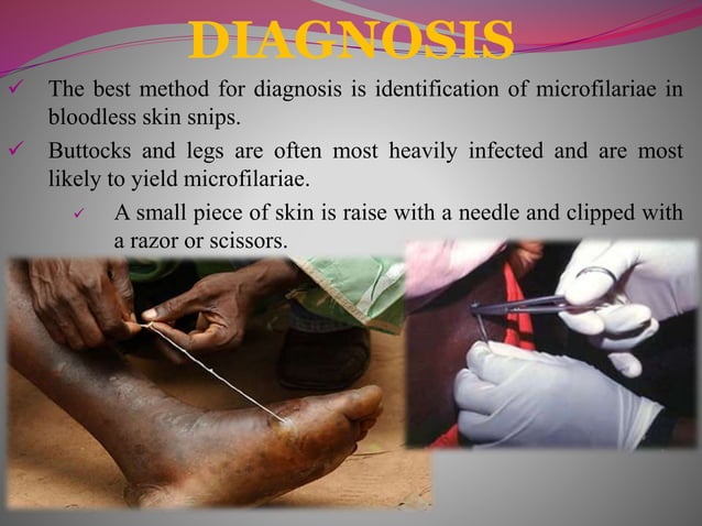 Onchocerciasis | PPTX